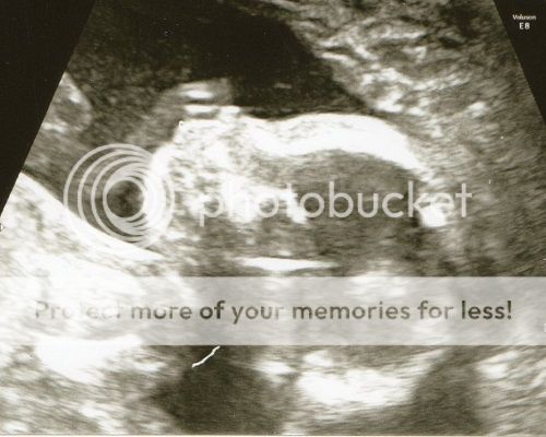 21.5-week Anomaly Scan | Journey to a Better Birth